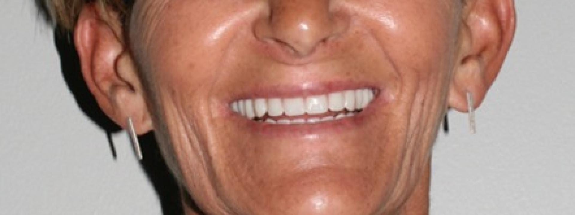 Pam Hybrid Implant Supported Denture Periodontics And Implant