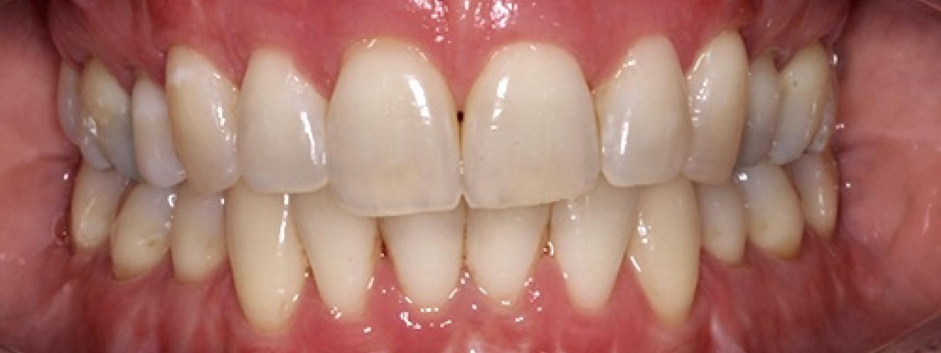 Jessica: Soft Tissue Grafting - Alloderm | Periodontics and Implant ...