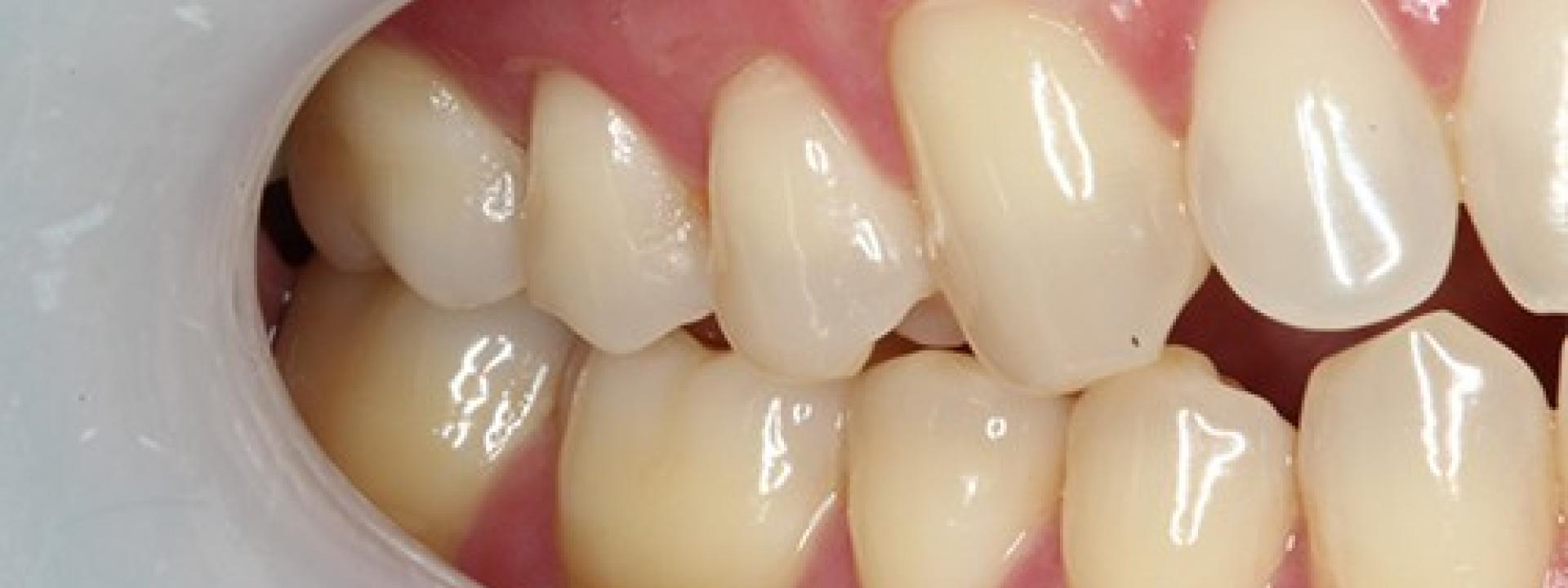 Tutoplast Patch Graft